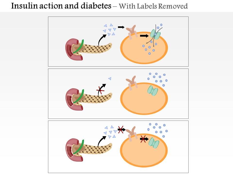 0714 Insulin action and diabetes type 1 and type 2 Medical Images For ...
