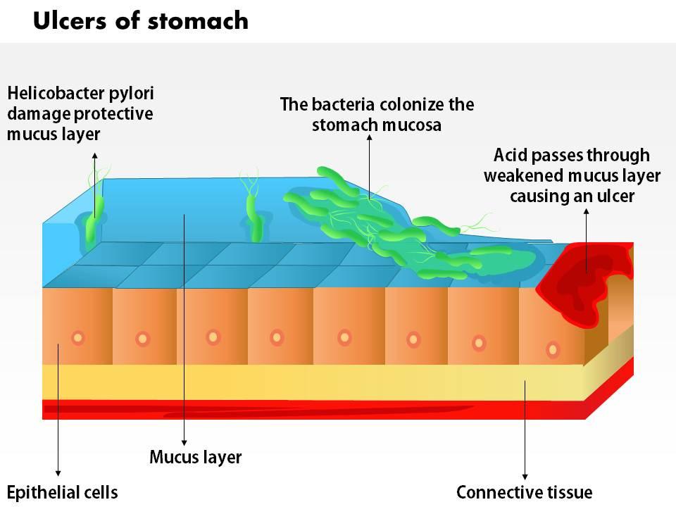 0814 Ulcers Of The Stomach And Duodenum Medical Images For Powerpoint ...