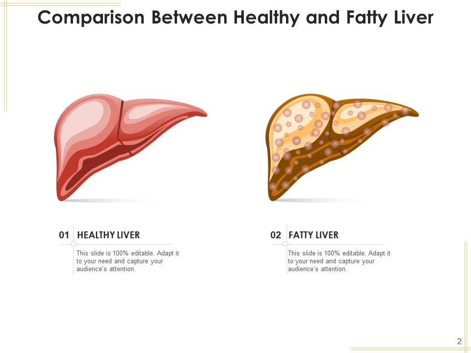 Fatty Liver Comparison Excessive Consumption Development Infographic ...